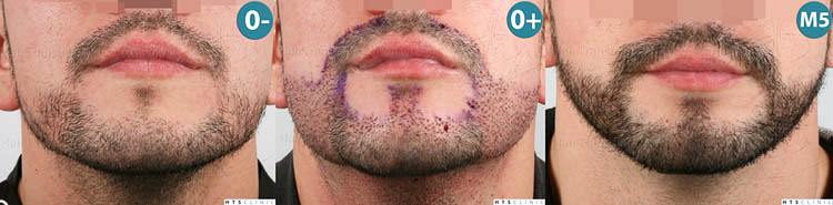 Dr. Jean Devroye Beard transplant procedure before and after result ...