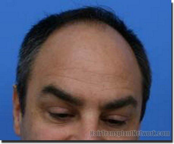 Dr. Glenn Charles Hair transplant surgery before and after photos
