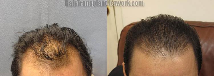 Dr. Paul Rose Hair transplant procedure before and after result ...