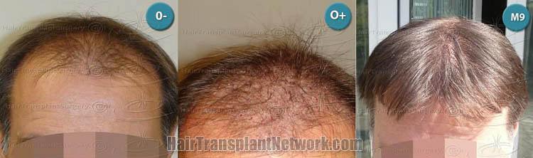 Dr. Jean Devroye Hair restoration surgery before and after result ...