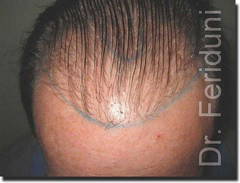 Hair transplant surgery before and after photos