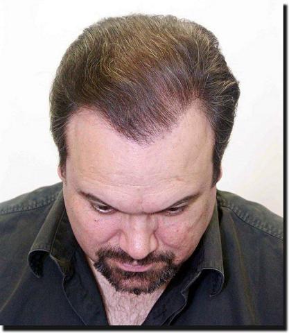 Dr. Bessam Farjo Hair transplant surgery before and after photos