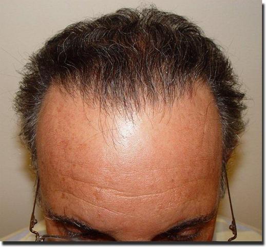 Dr. Bernard Nusbaum Hair transplant surgery before and after photos