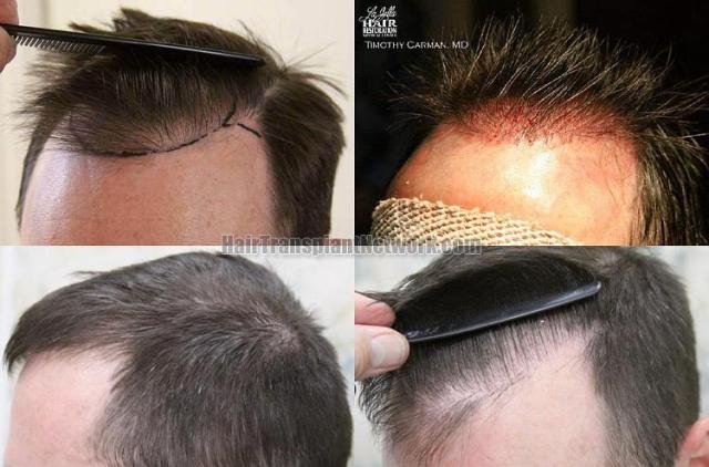 Dr Timothy Carman Hair Transplant Surgery And Scar Revision Before And